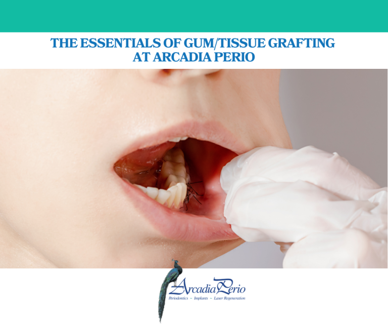 The Essentials of Gum Tissue Grafting at Arcadia Perio | Arcadia Perio